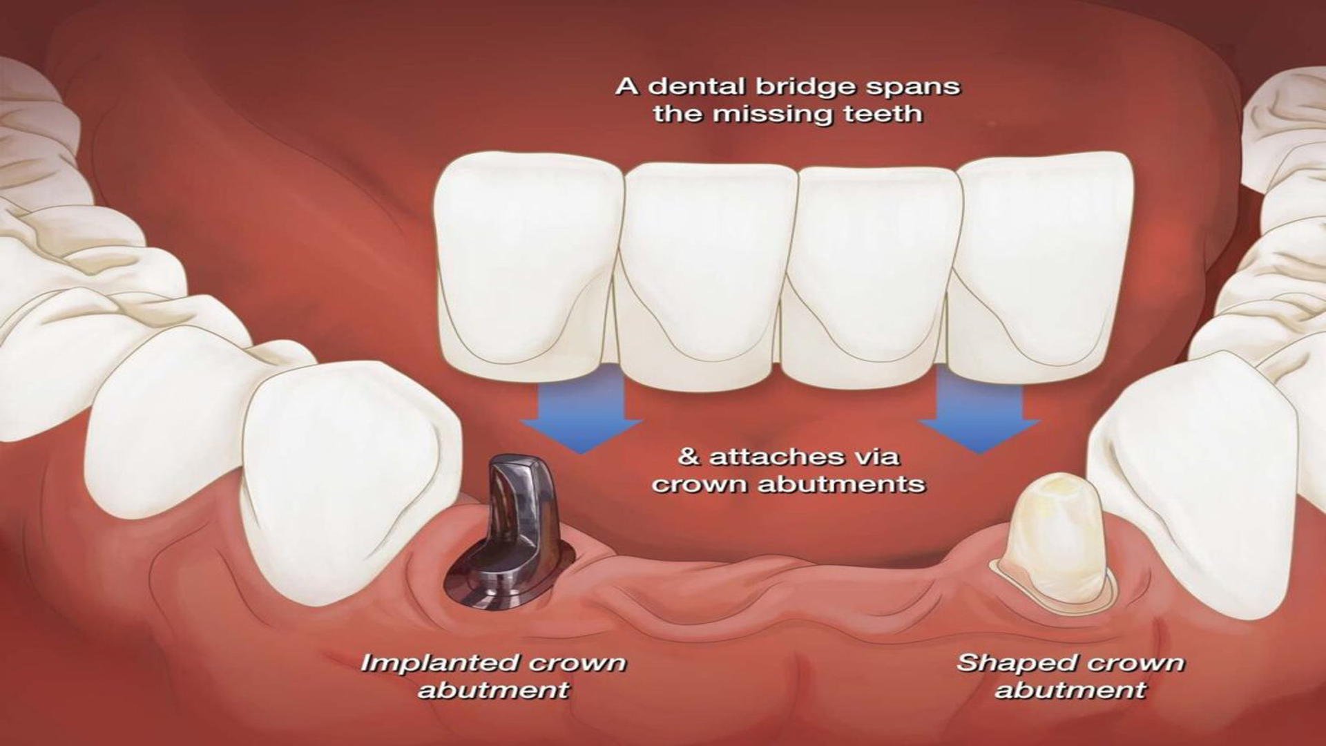 Bengaluru's Dental Clinic for Skilled Oral Bridge Solutions